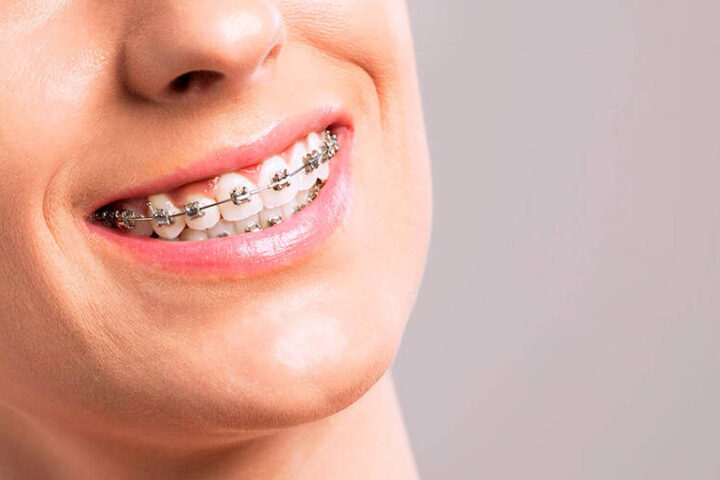 Brackets cerámicos de porcelana: ventajas estéticas | Ferrus&Bratos