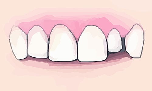 Microdoncia y macrodoncia: anomalías de tamaño en dientes