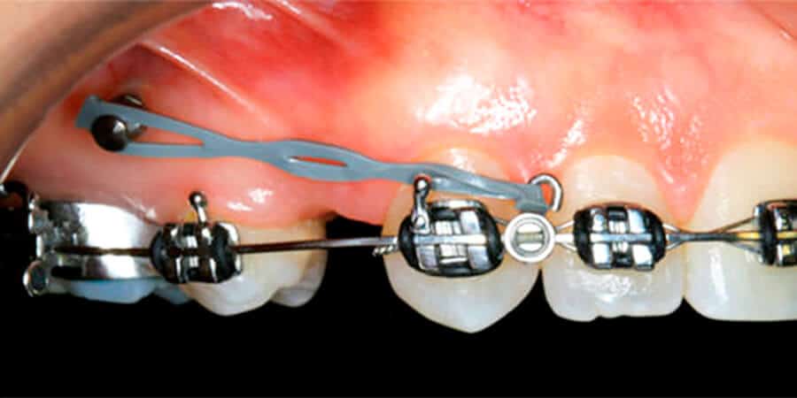 ¿Qué son los microtornillos de ortodoncia? | Ferrus&Bratos