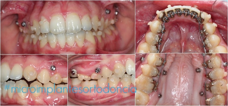 Por qué se usan los microtornillos ó microimplantes dentales
