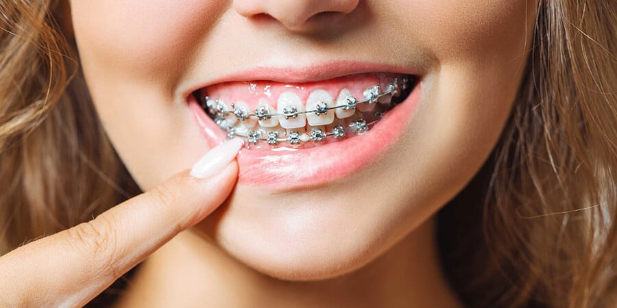 Brackets autoligables: ¿por qué elegirlos? | Ferrus&Bratos