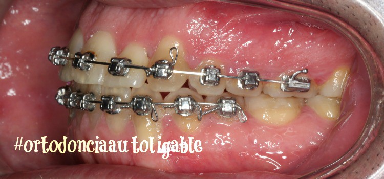 ¿Qué caracteriza a la ortodoncia autoligable?