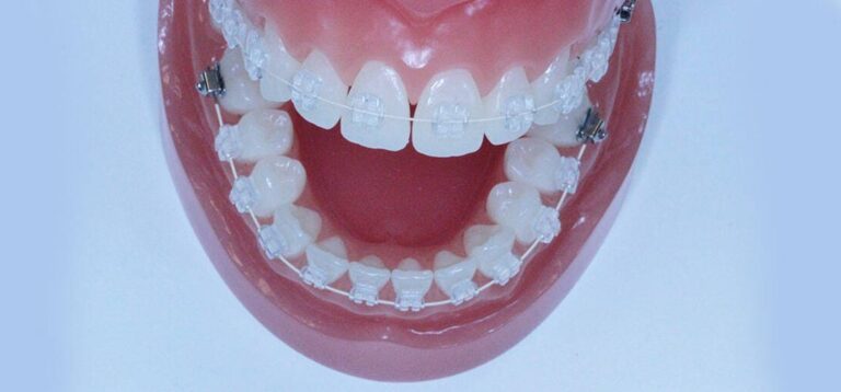 Brackets cerámicos de porcelana: ventajas estéticas | Ferrus&Bratos