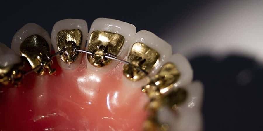 Ortodoncia lingual y brackets linguales: ventajas, FAQs y precios
