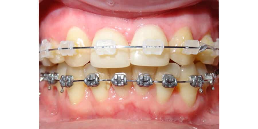 Ortodoncia mixta: ¿qué es y qué brackets puedo elegir? | Ferrus&Bratos