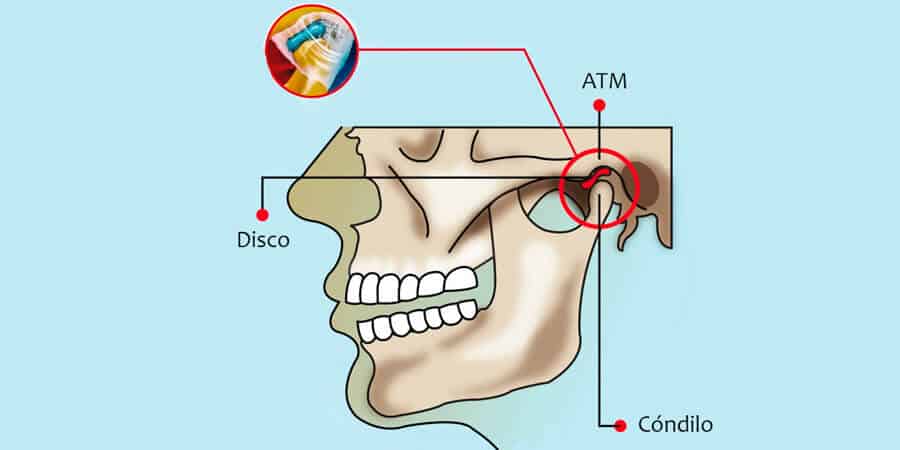 ¿Sabes cómo detectar los trastornos de la ATM? | Ferrus&Bratos