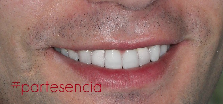 Tipos de encía y enfermedades que la afectan- Ferrus & Bratos