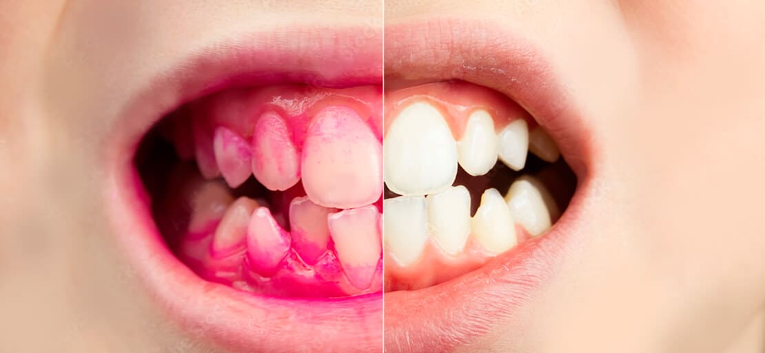 Plac Control: ¿qué es el revelador de placa bacteriana?