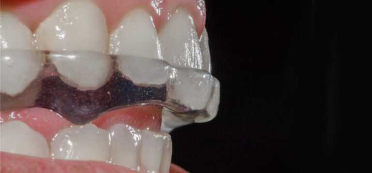 Férula de descarga: precio en 【 2025 】Ferrus&Bratos