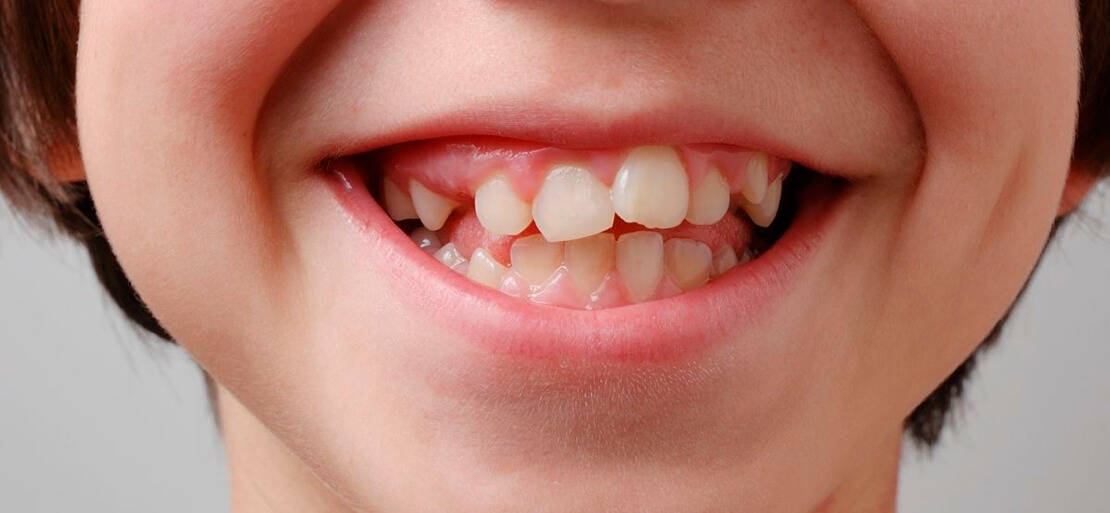 Protrusión dental: ¿cuál es su impacto y cómo se corrige?