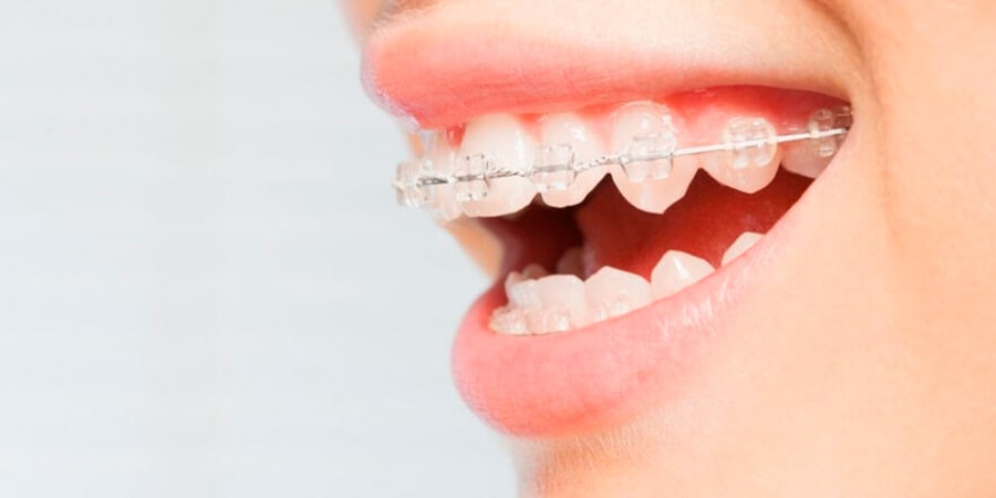 Protrusión dental: ¿cuál es su impacto y cómo se corrige?