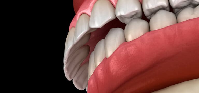 Protrusión dental: ¿cuál es su impacto y cómo se corrige?