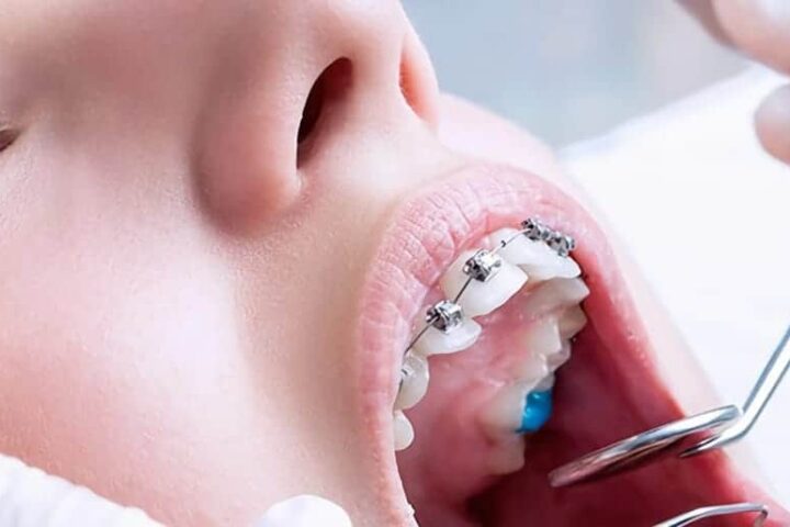 Protrusión dental: ¿cuál es su impacto y cómo se corrige?