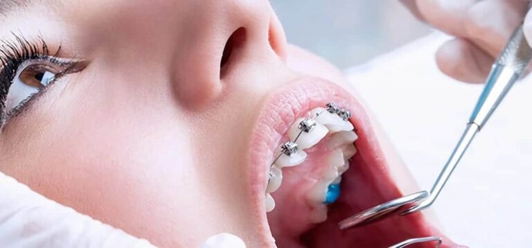 Prognatismo mandibular: causas y tratamiento | Ferrus & Bratos