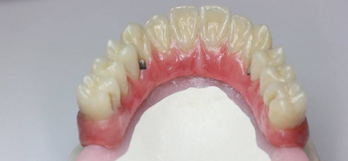 ¿Qué función tiene un diente provisional? | Ferrus&Bratos