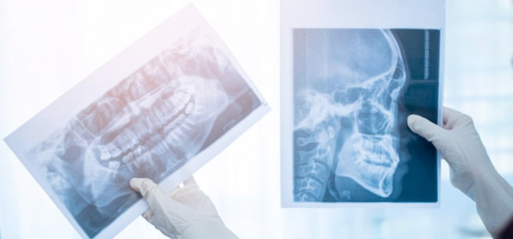 Dientes supernumerarios: causas y tratamiento | Clínica Ferrus & Bratos