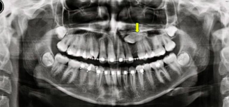 Tratamientos efectivos para corregir los dientes incluidos | Ferrus&Bratos