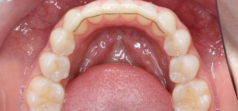 Retenedores dentales de ortodoncia: qué son | Ferrus&Bratos