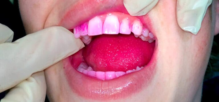 Plac Control: ¿qué es el revelador de placa bacteriana?