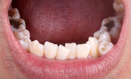 Dientes supernumerarios: causas y tratamiento | Clínica Ferrus & Bratos