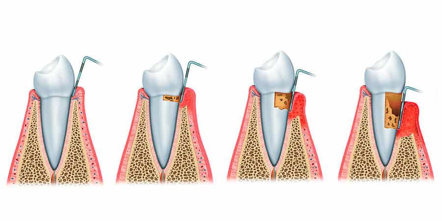 Los 3 peores efectos del tabaco en tu boca | Ferrus&Bratos