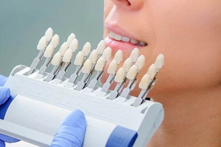 Diente calcificado: causas y solución para dientes amarillos | Ferrus ...