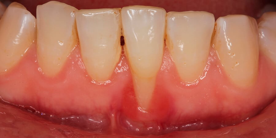 Tipos de encía y los cuidados que necesitan | Ferrus&Bratos