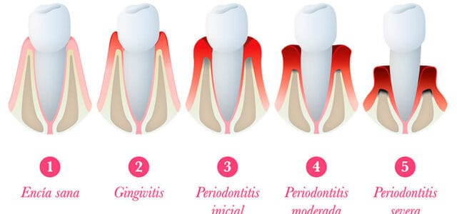 Tipos de gingivitis y cómo tratar las encías enfermas | Ferrus&Bratos