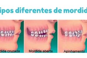 Problemas de mordida ¿Como los solucionamos?