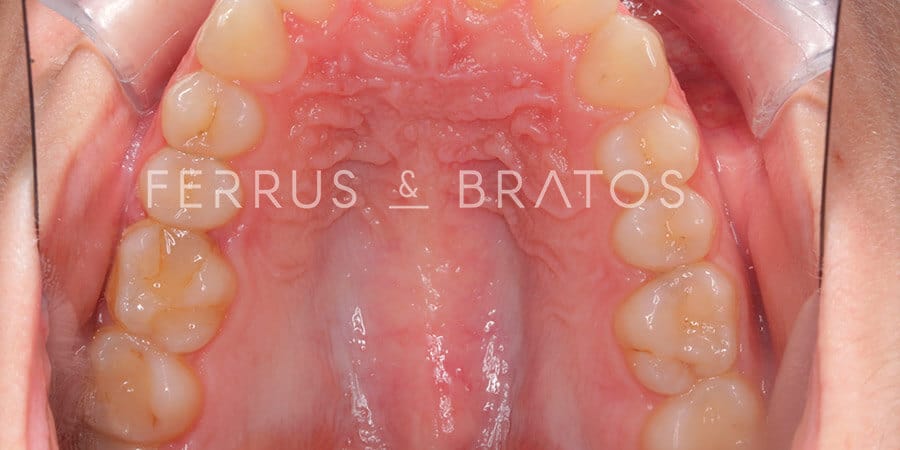 Torus mandibular: ¿qué es y cómo se trata? | Ferrus&Bratos