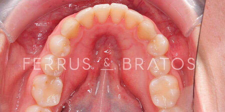 Torus mandibular: ¿qué es y cómo se trata? | Ferrus&Bratos