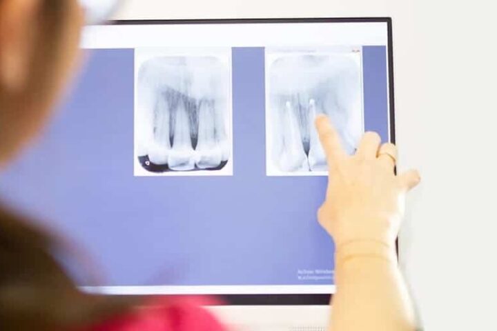 Hongos en la boca: ¿qué son y cuál es su tratamiento?